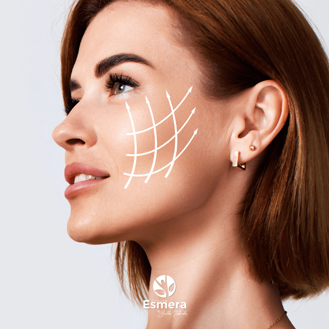 LIFTING SIN CIRUGÍA – CLINICA ESMERA